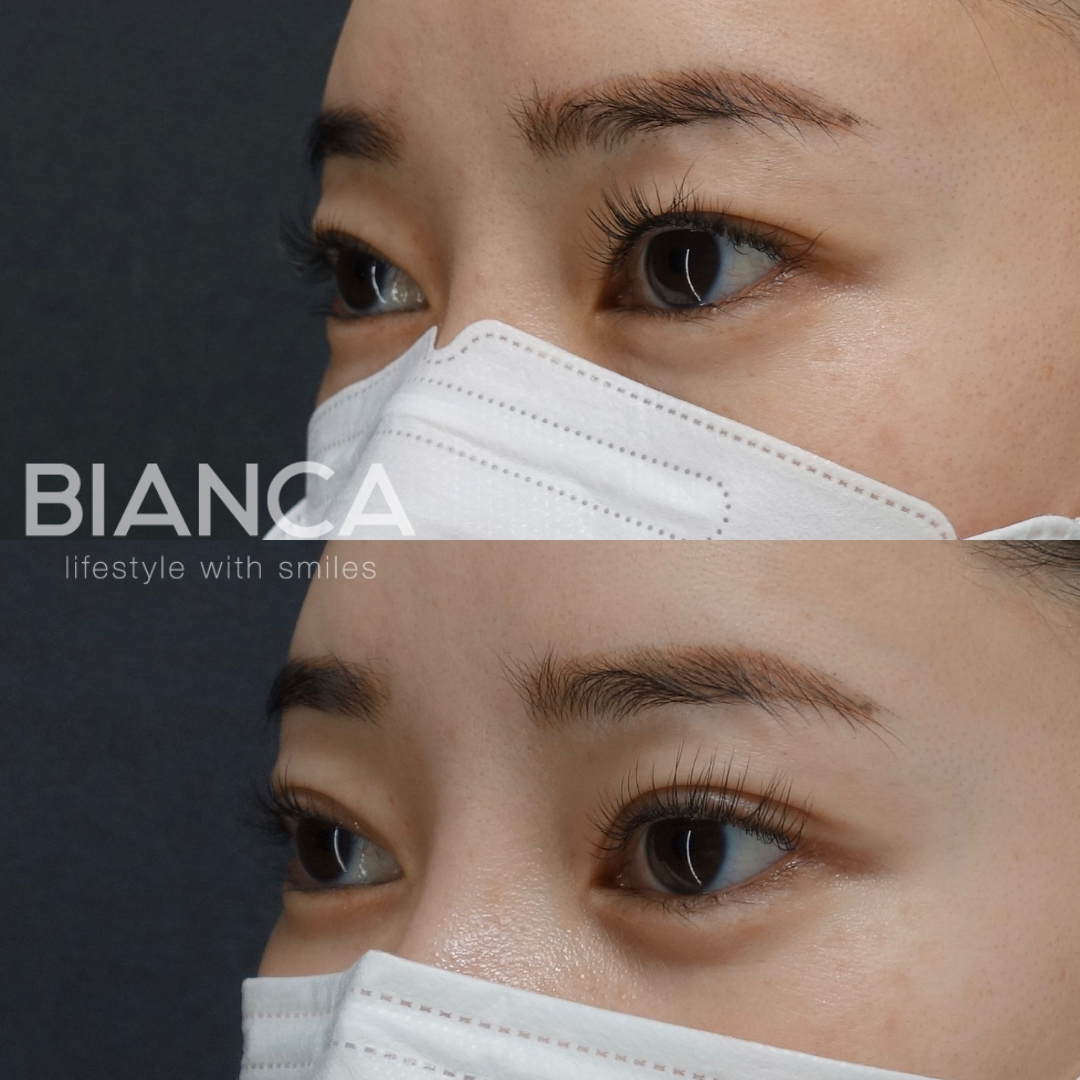 二重埋没法4点留め 術後1ヶ月 | 日本を代表する美容健康再生医療のクリニック｜BIANCAGINZA