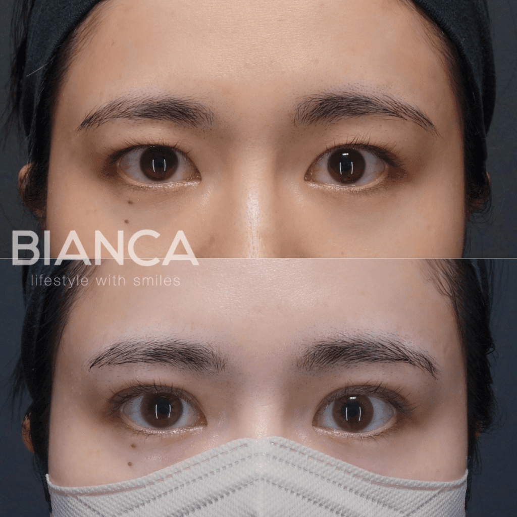 二重埋没法4点留め 術後1カ月 | 日本を代表する美容健康再生医療のクリニック｜BIANCAGINZA