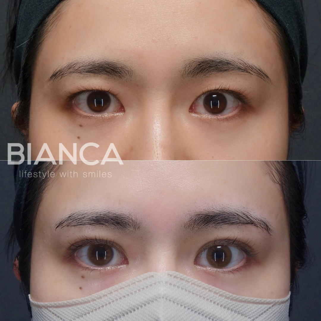 二重埋没法4点留め 術後1カ月 | 日本を代表する美容健康再生医療のクリニック｜BIANCAGINZA