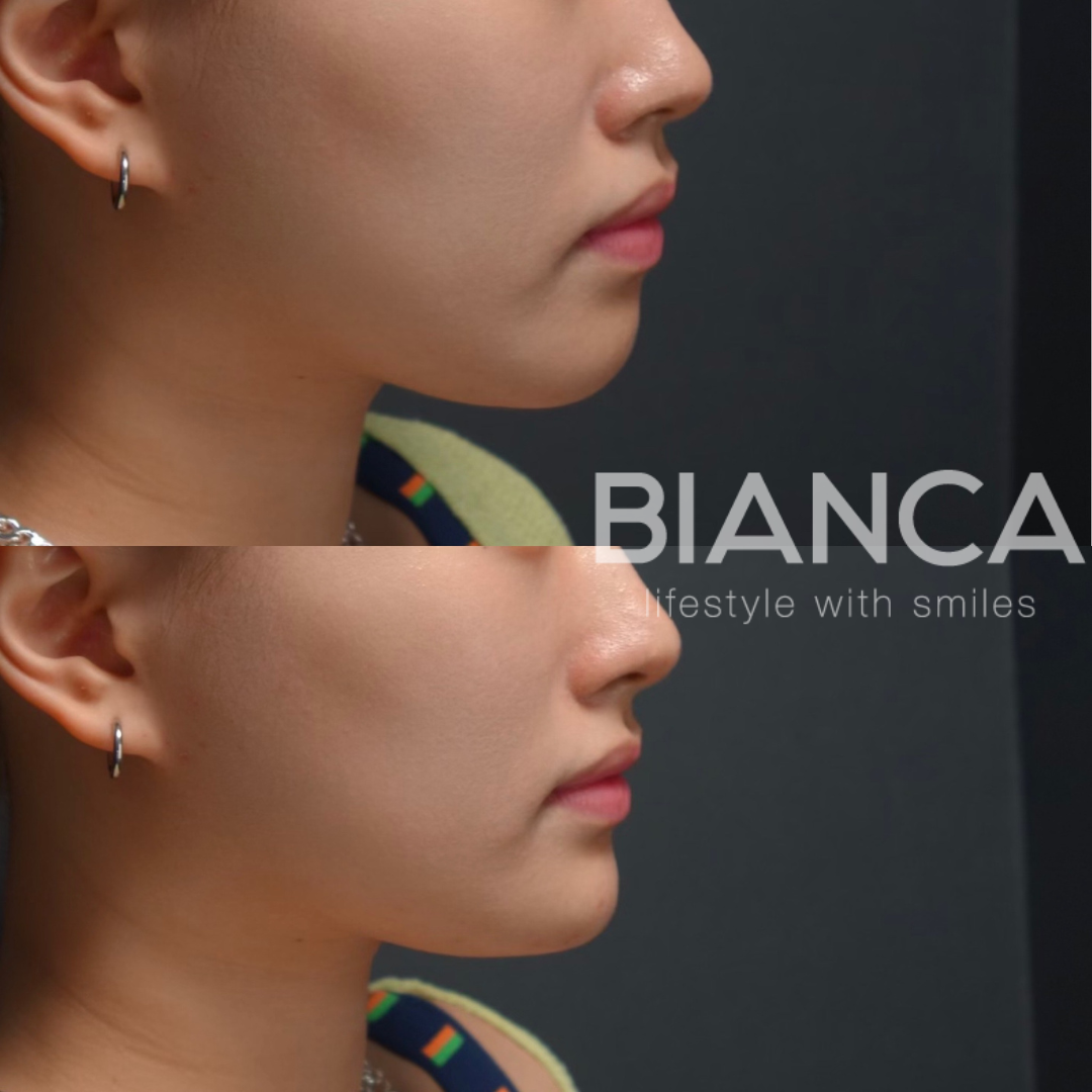 ヒアルロン酸(鼻先、鼻筋、顎) | 日本を代表する美容健康再生医療のクリニック｜BIANCAGINZA