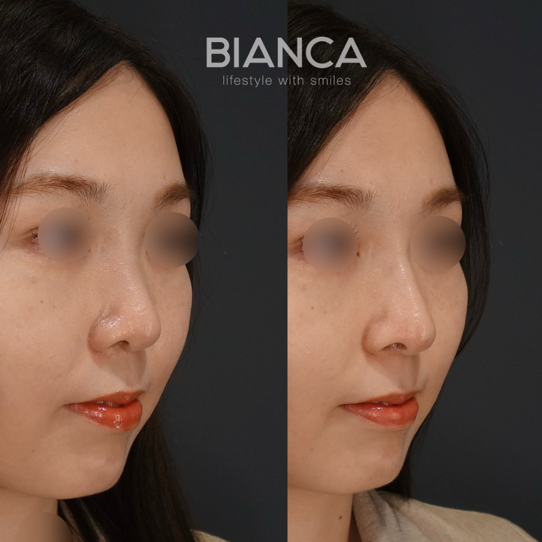 鼻ヒアルロン酸 | 日本を代表する美容健康再生医療のクリニック｜BIANCAGINZA