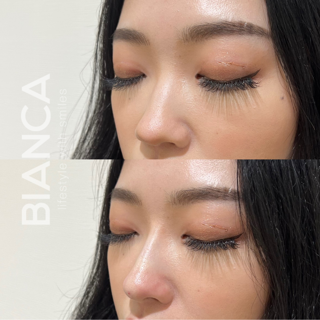 ヒアルの常識を変える鼻ヒアルロン酸 | 日本を代表する美容健康再生医療のクリニック｜BIANCAGINZA