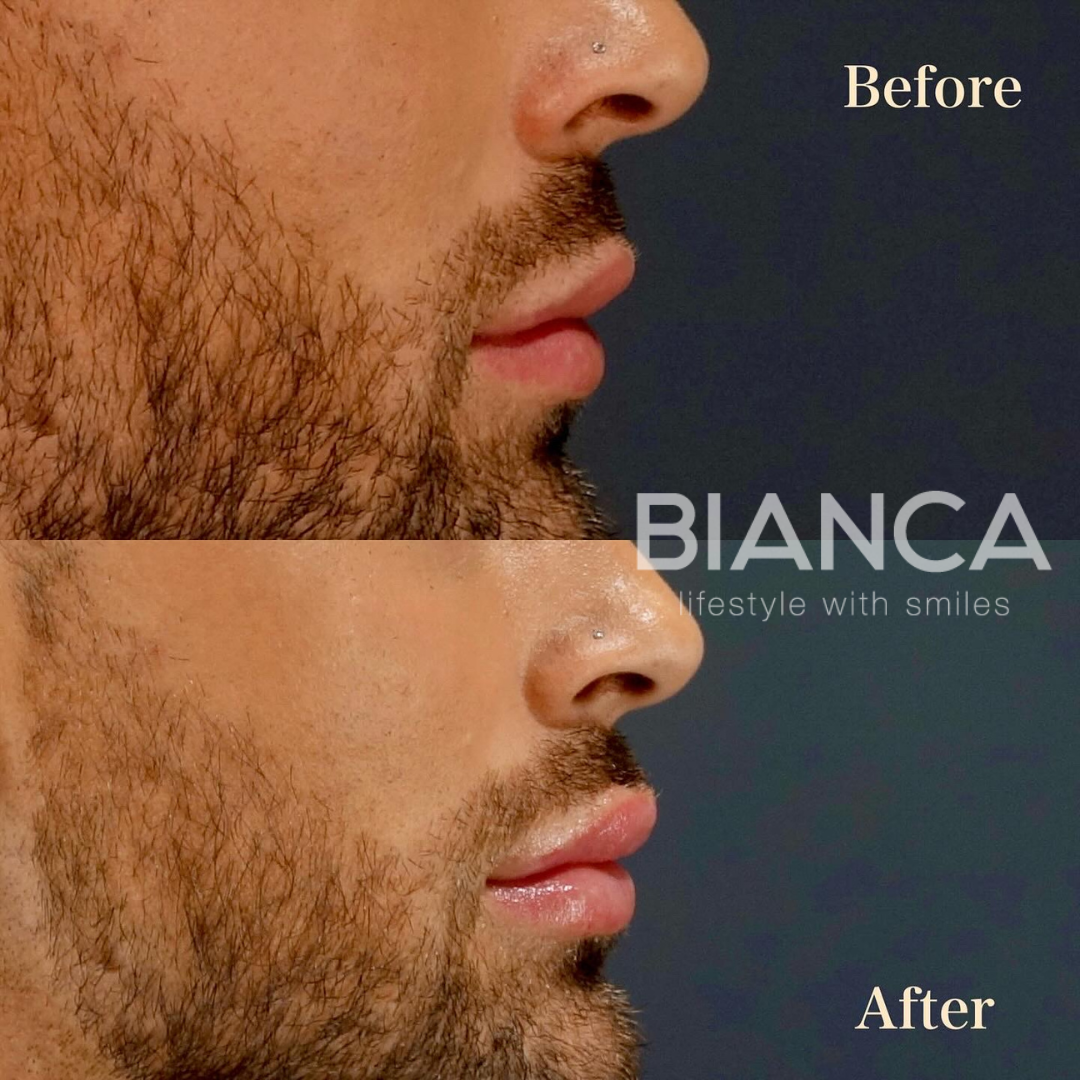 ロシアンリップ | 日本を代表する美容健康再生医療のクリニック｜BIANCAGINZA