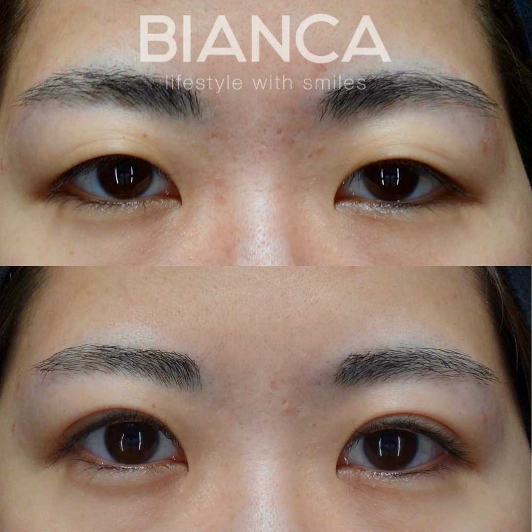 二重埋没法4点留め 術後2週間 | 日本を代表する美容健康再生医療のクリニック｜BIANCAGINZA