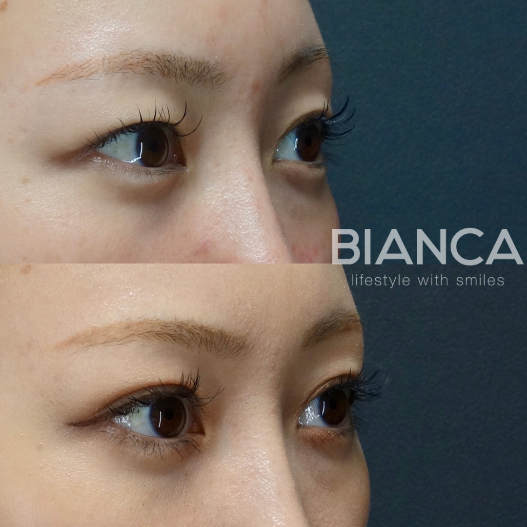 二重埋没法4点留め 術後2カ月 | 日本を代表する美容健康再生医療のクリニック｜BIANCAGINZA