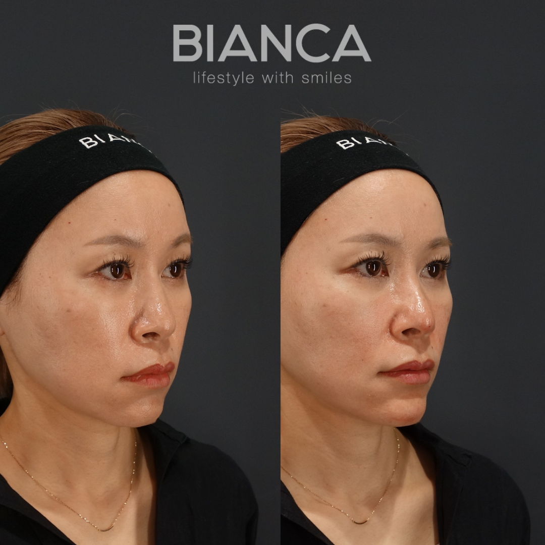 ヒアルロン酸（鼻先〜鼻筋,鼻翼基部,顎） | 日本を代表する美容健康再生医療のクリニック｜BIANCAGINZA