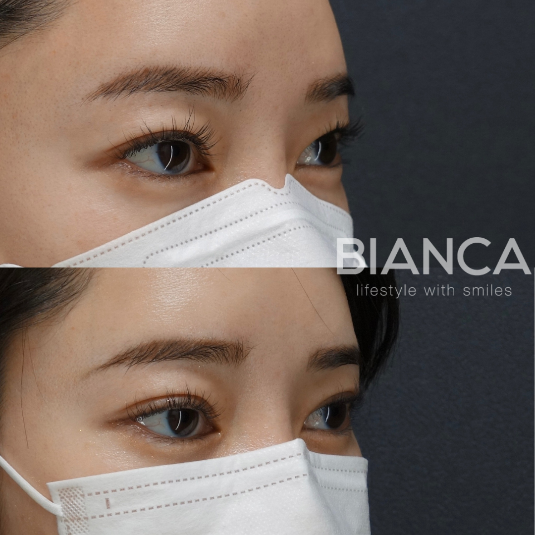 二重埋没法4点留め 術後1ヶ月 | 日本を代表する美容健康再生医療のクリニック｜BIANCAGINZA