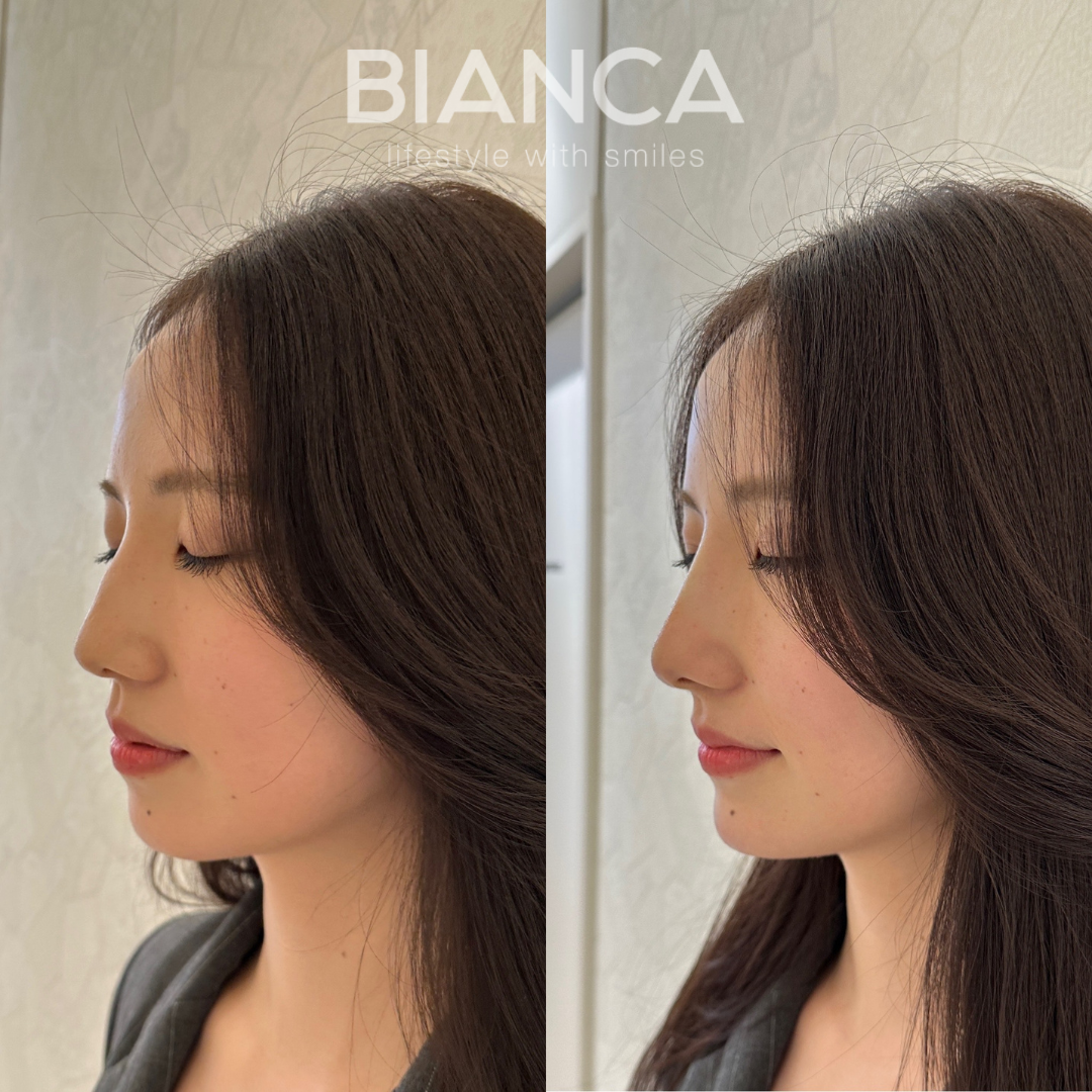 ヒアルロン酸(鼻先、鼻筋、顎) | 日本を代表する美容健康再生医療のクリニック｜BIANCAGINZA