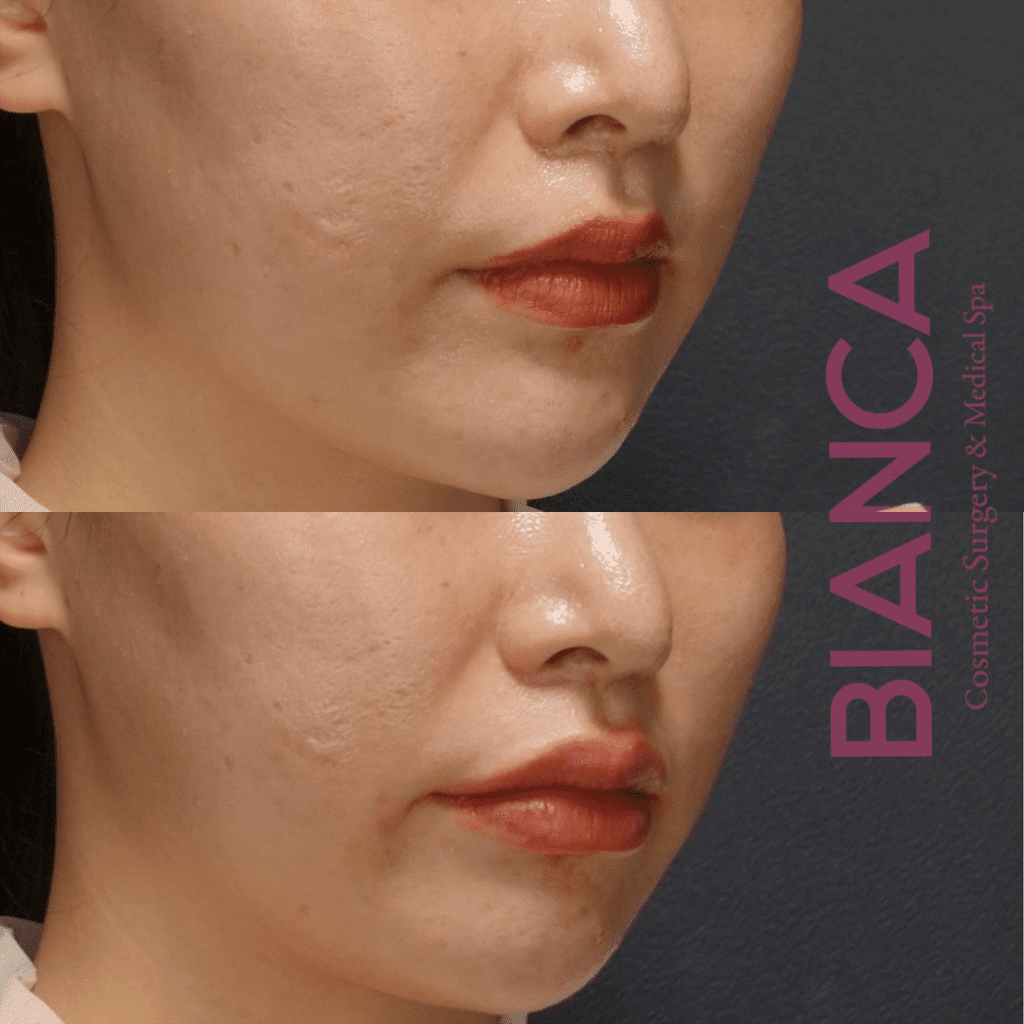 リップヒアルロン酸 | 日本を代表する美容健康再生医療のクリニック｜BIANCAGINZA