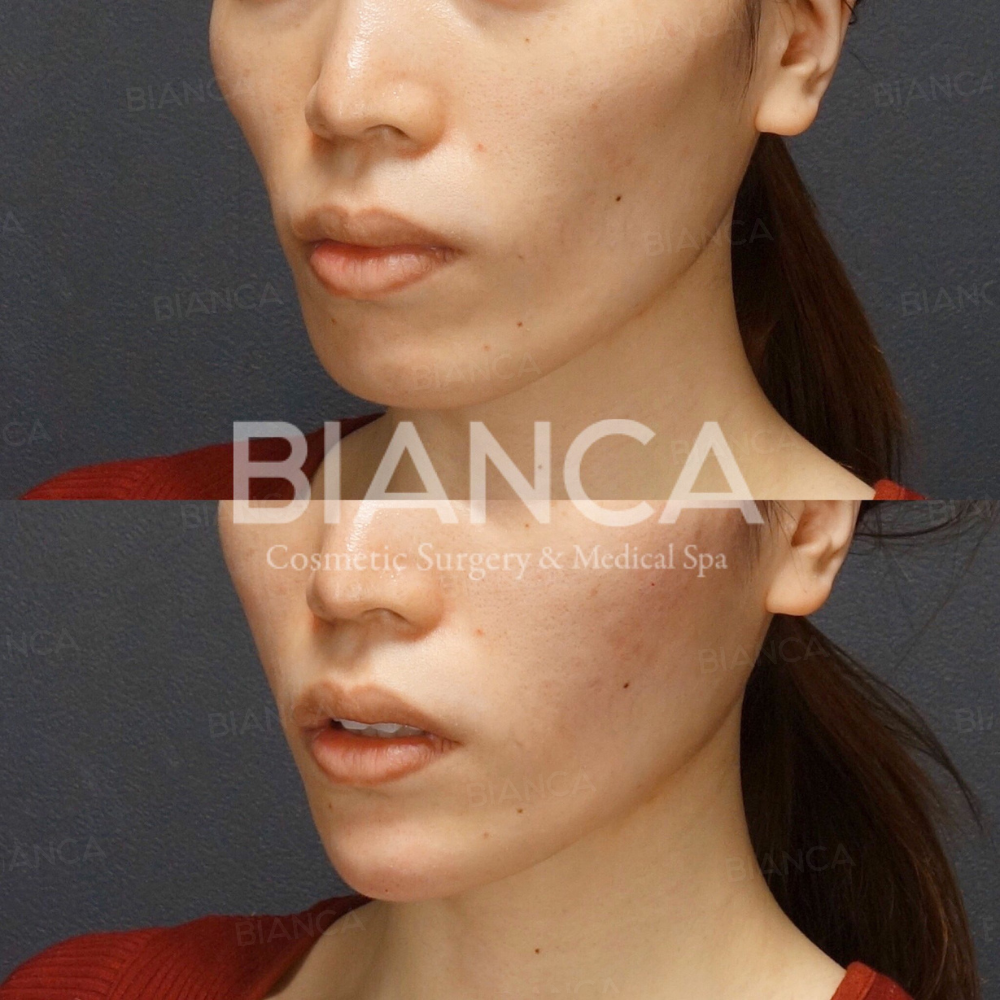 ヒアルロン酸注射（頬こけ）リッチ 6｜銀座・表参道にあるBIANCA CLINIC ビアンカクリニック｜美容外科・美容皮膚科・再生医療・美容 ...